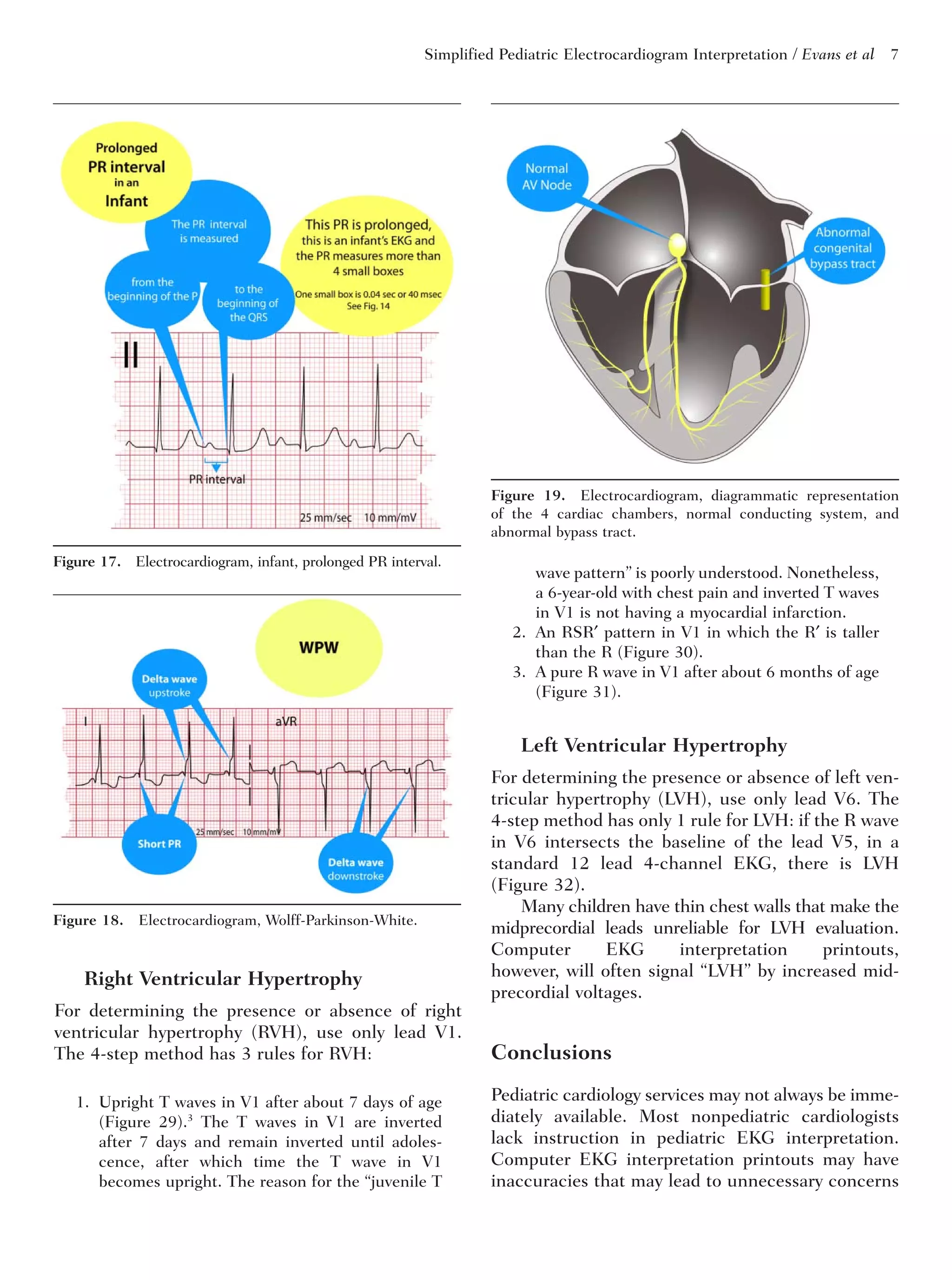 Simplified pediatric electrocardiogram interpretation | PDF