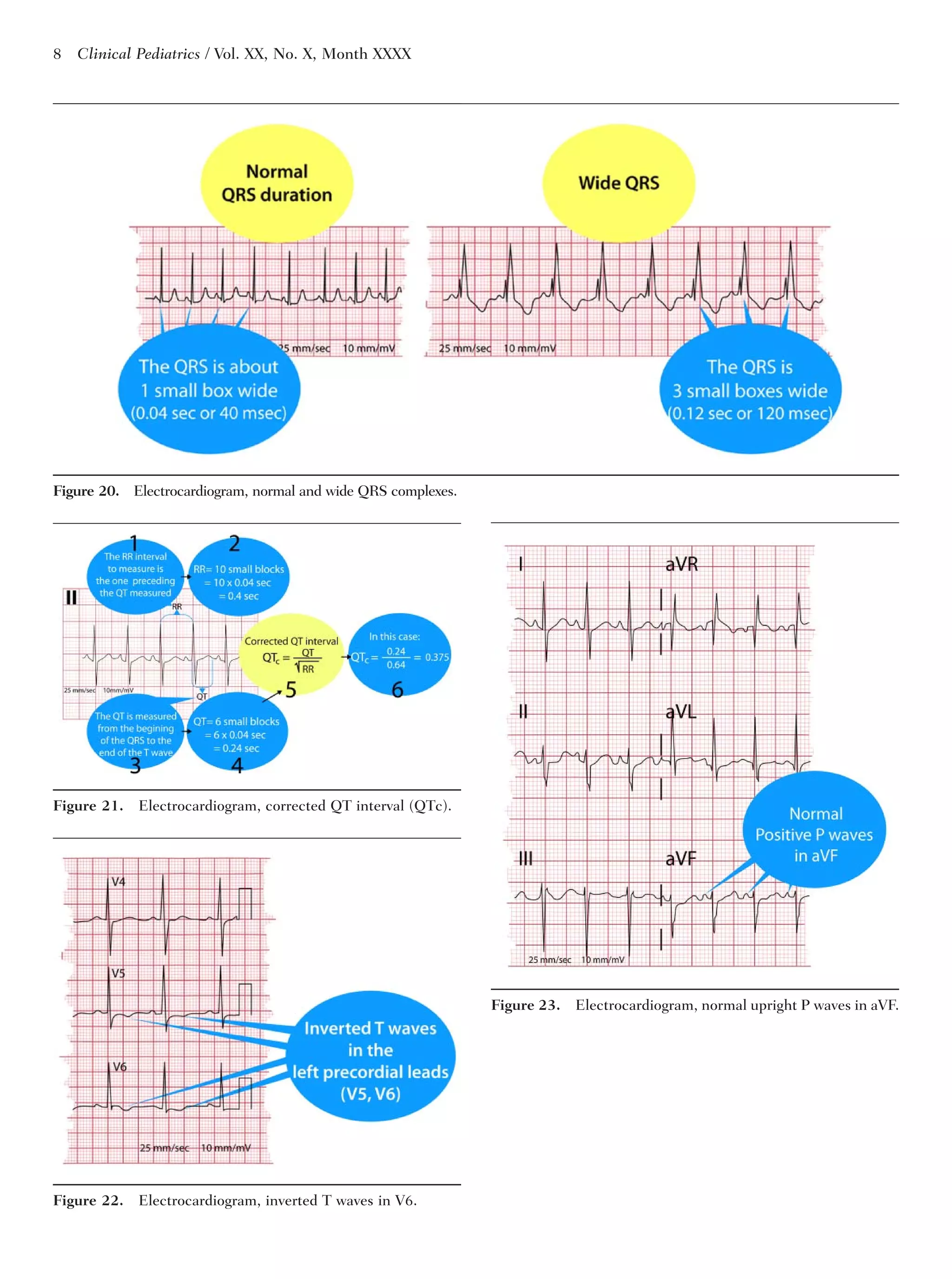 Simplified pediatric electrocardiogram interpretation | PDF