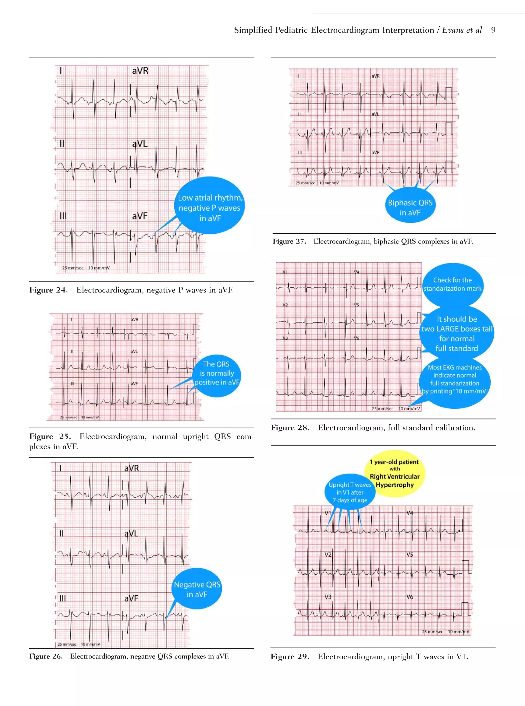 Simplified pediatric electrocardiogram interpretation | PDF