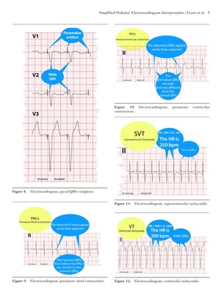 Simplified pediatric electrocardiogram interpretation | PDF