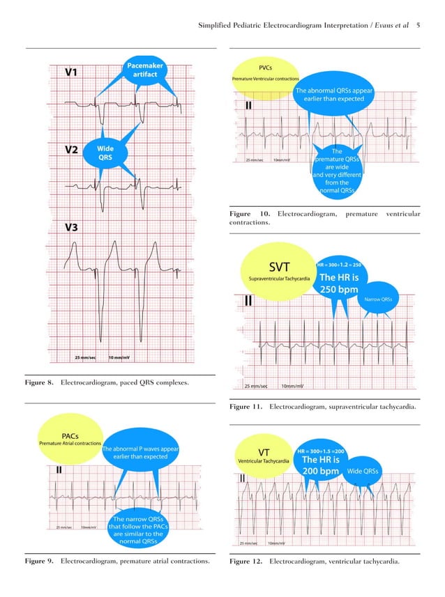 Simplified pediatric electrocardiogram interpretation | PDF