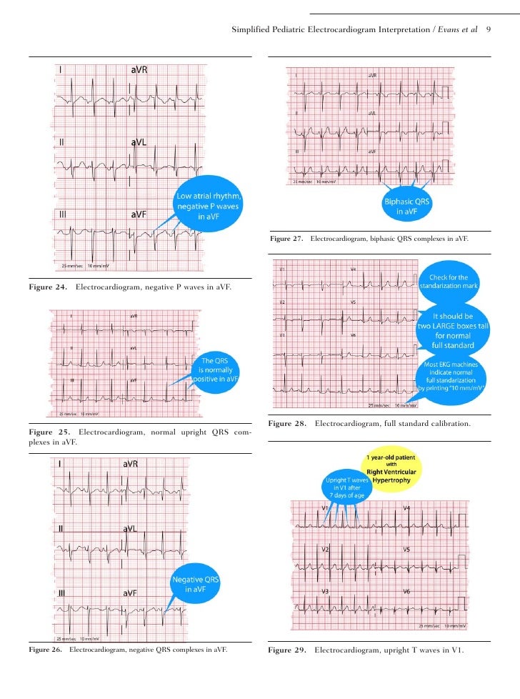 Simplified pediatric electrocardiogram interpretation