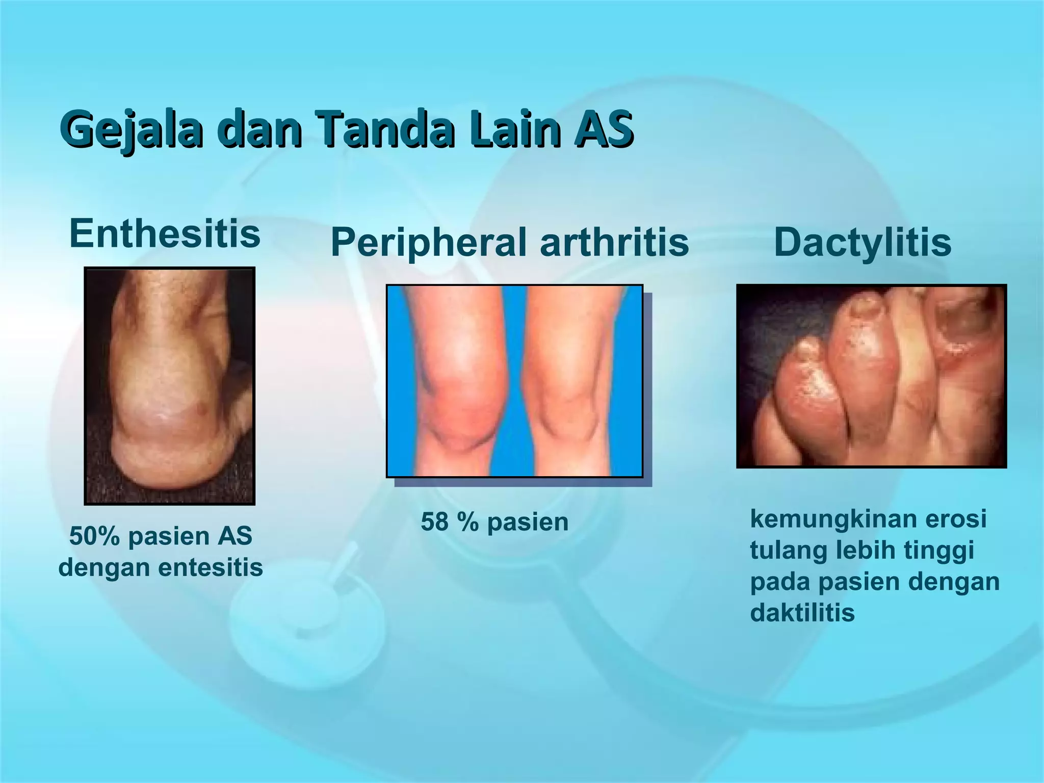 Mengenal ragam penyakit Autoimun | PPT