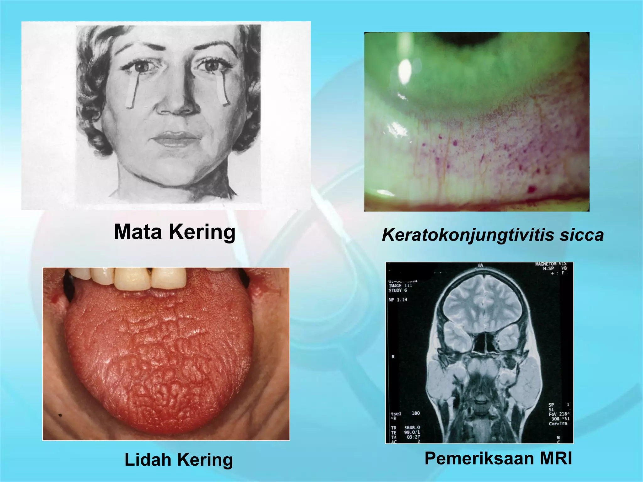 Mengenal ragam penyakit Autoimun | PPT