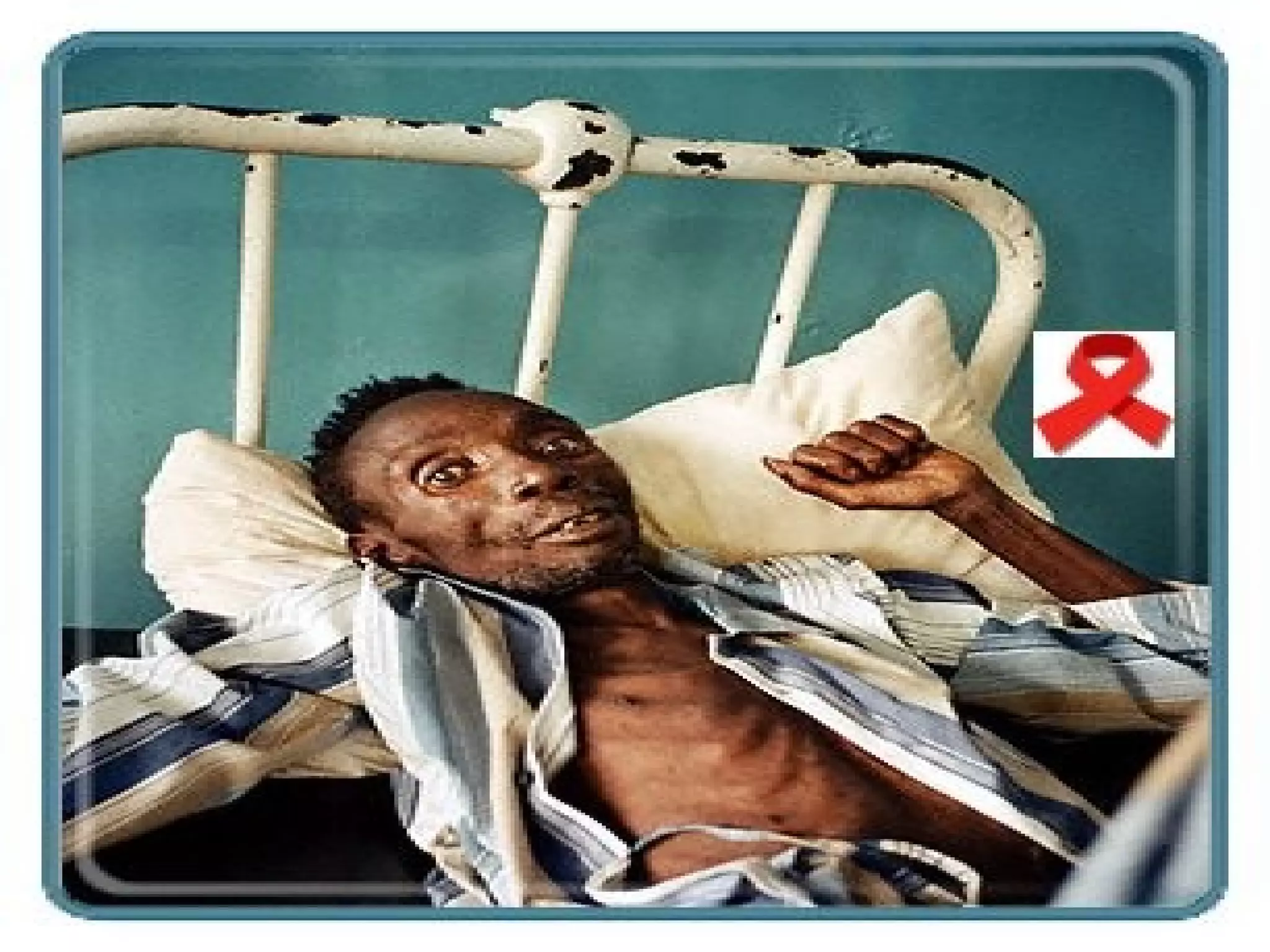 Simptomi i klinicki formi na tuberkuloza | PPT