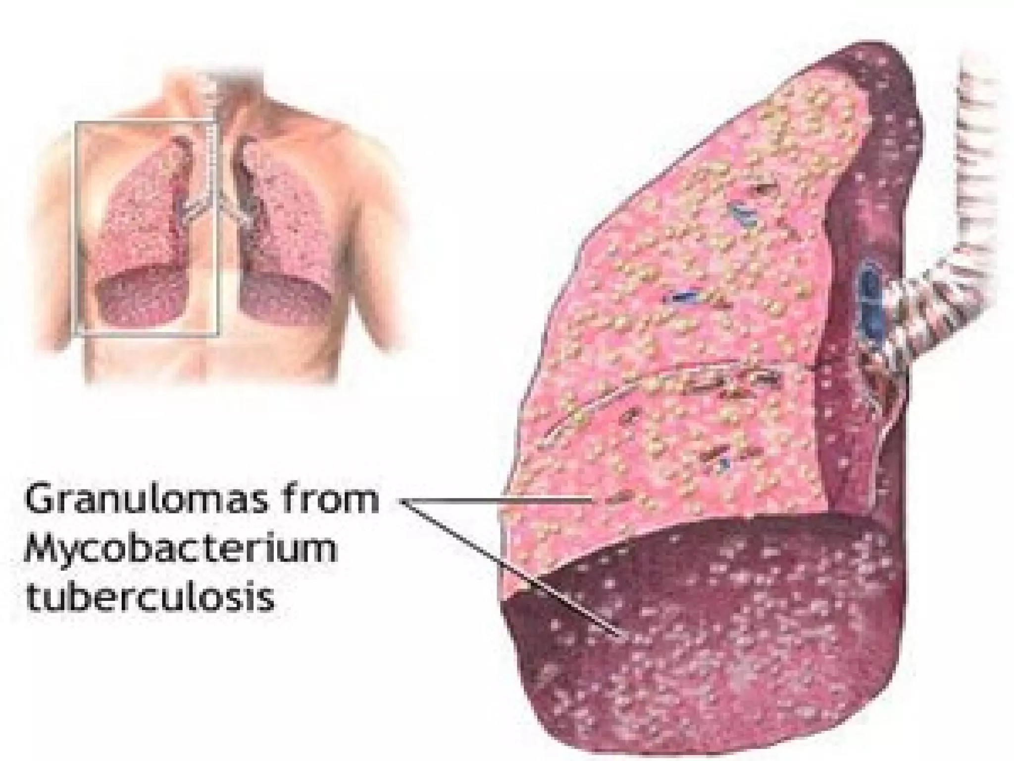 Simptomi i klinicki formi na tuberkuloza | PPT