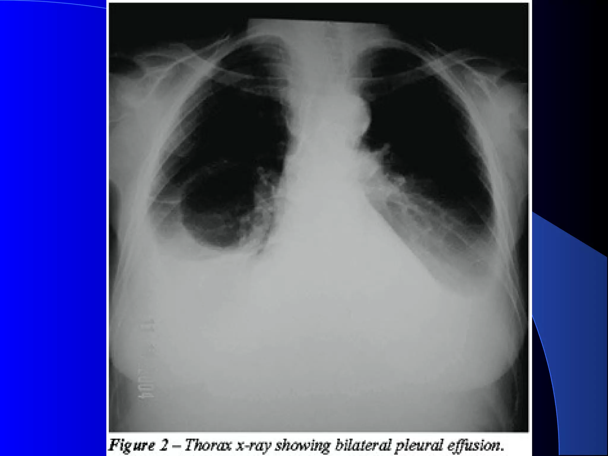 Simptomi i klinicki formi na tuberkuloza | PPT
