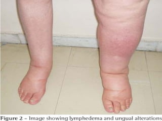 Simptomi i klinicki formi na tuberkuloza | PPT