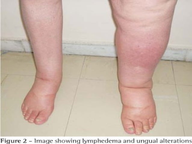 Simptomi i klinicki formi na tuberkuloza | PPT