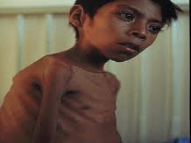 Simptomi i klinicki formi na tuberkuloza | PPT