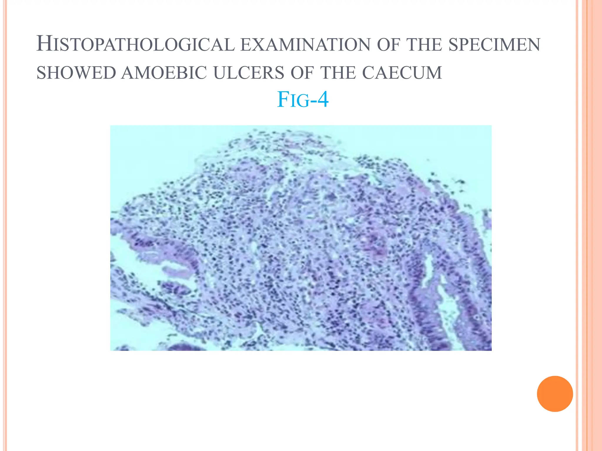 Simultaneous Amoebic Caecal Perforation with Ruptured Liver Abscess.pptx