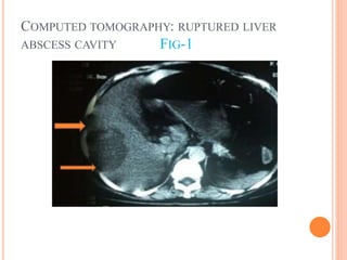 Simultaneous Amoebic Caecal Perforation with Ruptured Liver Abscess.pptx