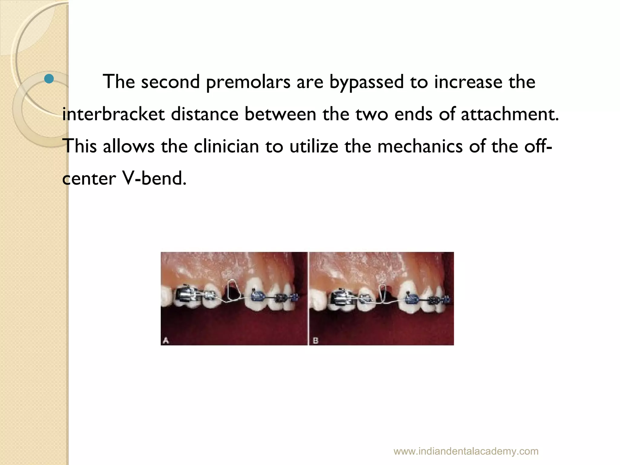 Simultaneous intrusion and retraction of the anterior teeth | PPT