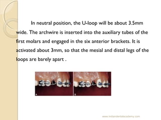 Simultaneous intrusion and retraction of the anterior teeth | PPT