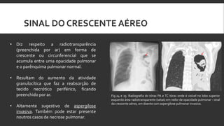 Sinais_clássicos_em_radiologia_do_tórax.pdf