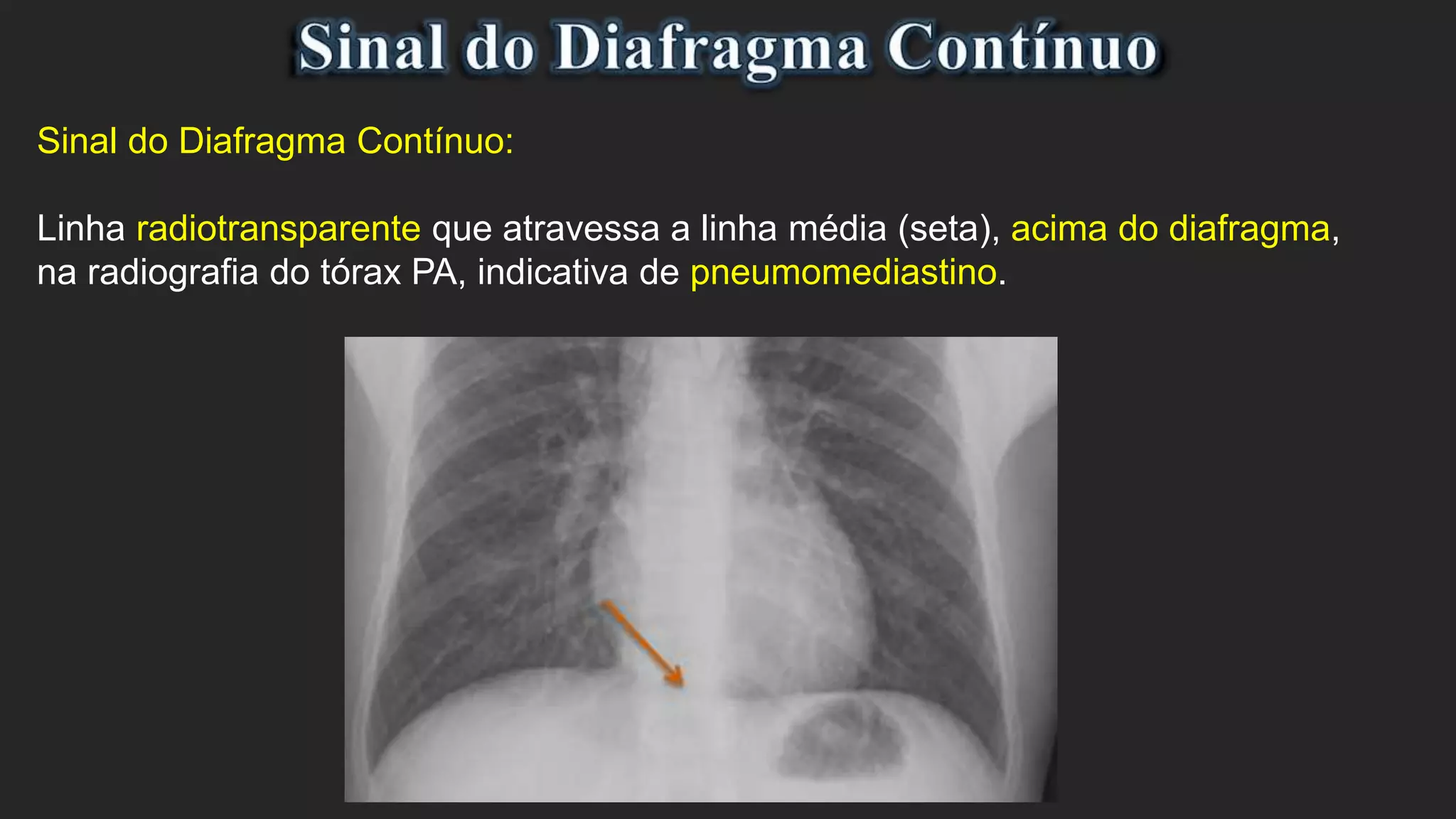 Sinais do Raio X de Tórax | PPTX