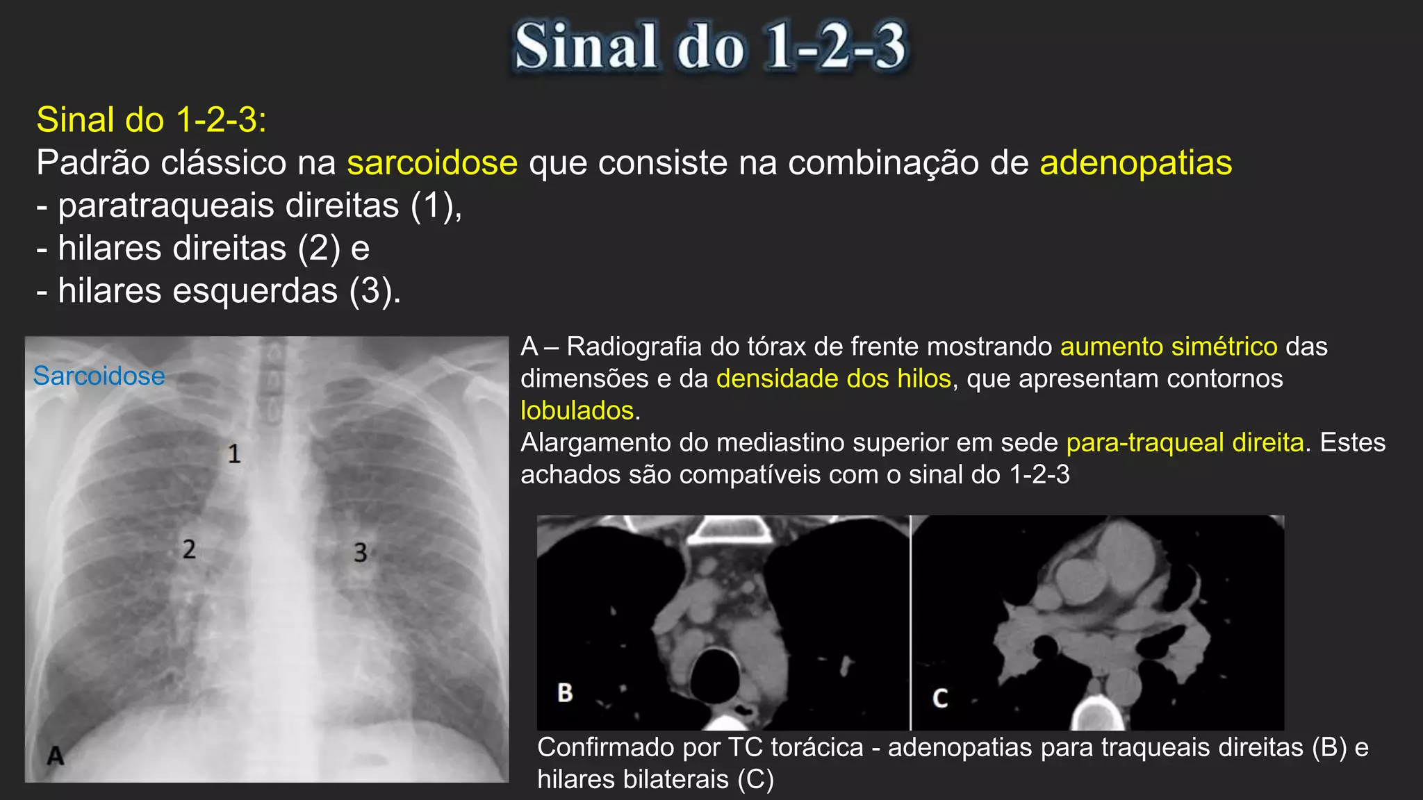 Sinais do Raio X de Tórax | PPTX | Lung and Respiratory Health ...