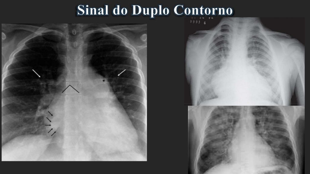 Sinais do Raio X de Tórax