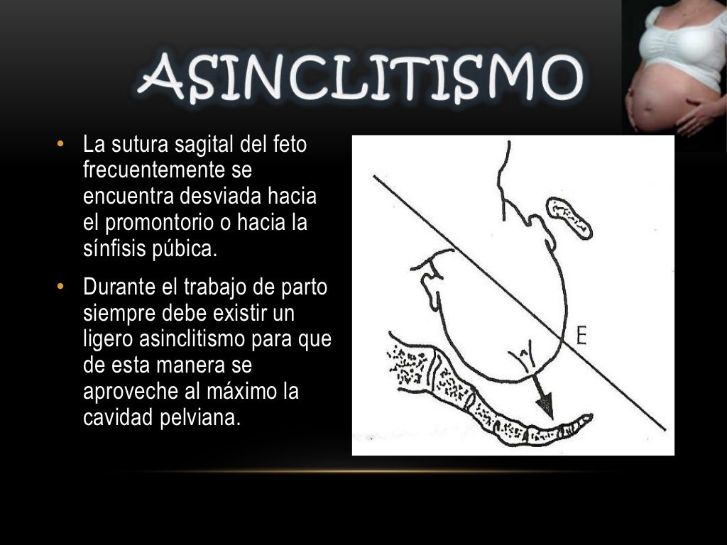 Sinclitismo y asinclitismo
