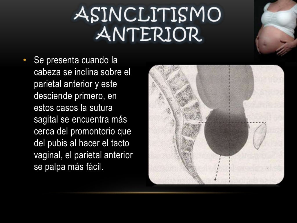 Sinclitismo y asinclitismo