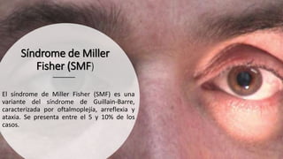 Sindrome de miller fisher | PPTX