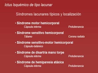 SINDROME VERTEBROBASILAR | PPTX
