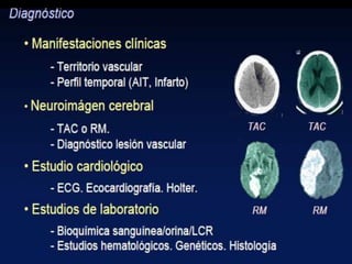 SINDROME VERTEBROBASILAR | PPTX