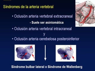SINDROME VERTEBROBASILAR | PPTX