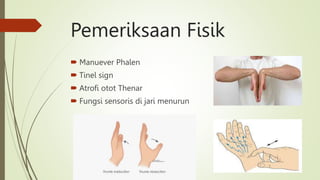 Sindrom Carpal Tunnel.pptx