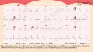sindrome-coronario-agudo-sin-st.pptx.CARDIOLOGIA | PPTX