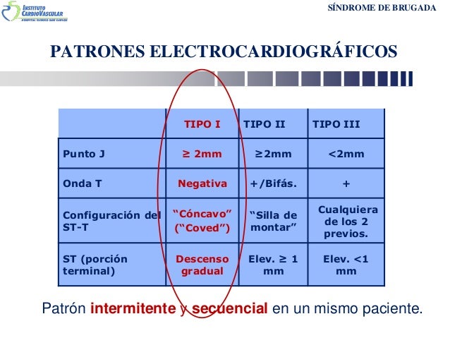 Síndrome de Brugada