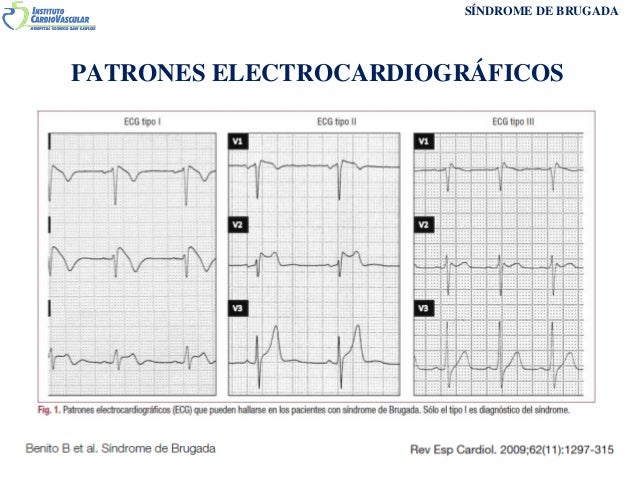 Síndrome de Brugada