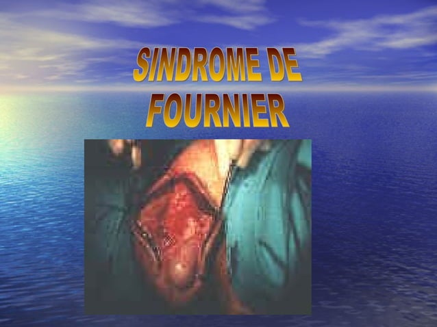 Sindrome De Fournier