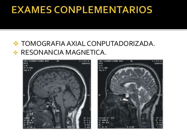 Sindrome de la silla turca vacia
