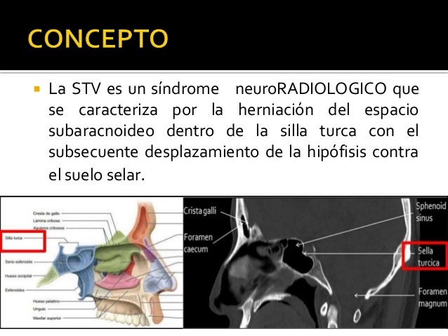 Sindrome de la silla turca vacia
