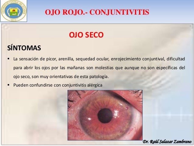 Sindrome de-ojo-rojo-optometria
