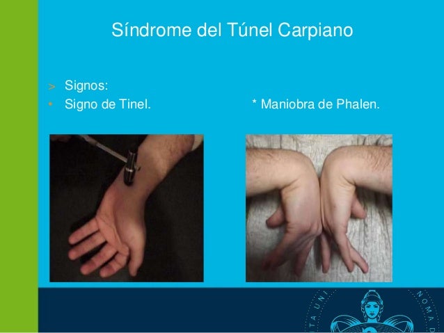 Sindrome del-tunel-carpiano