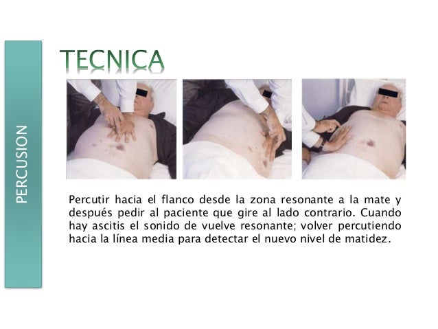 Semiologia Medica- Sindrome ascitico