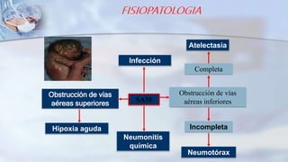 SINDROME ASPIRACION DE MECONIO EN NEONATOS | PPTX