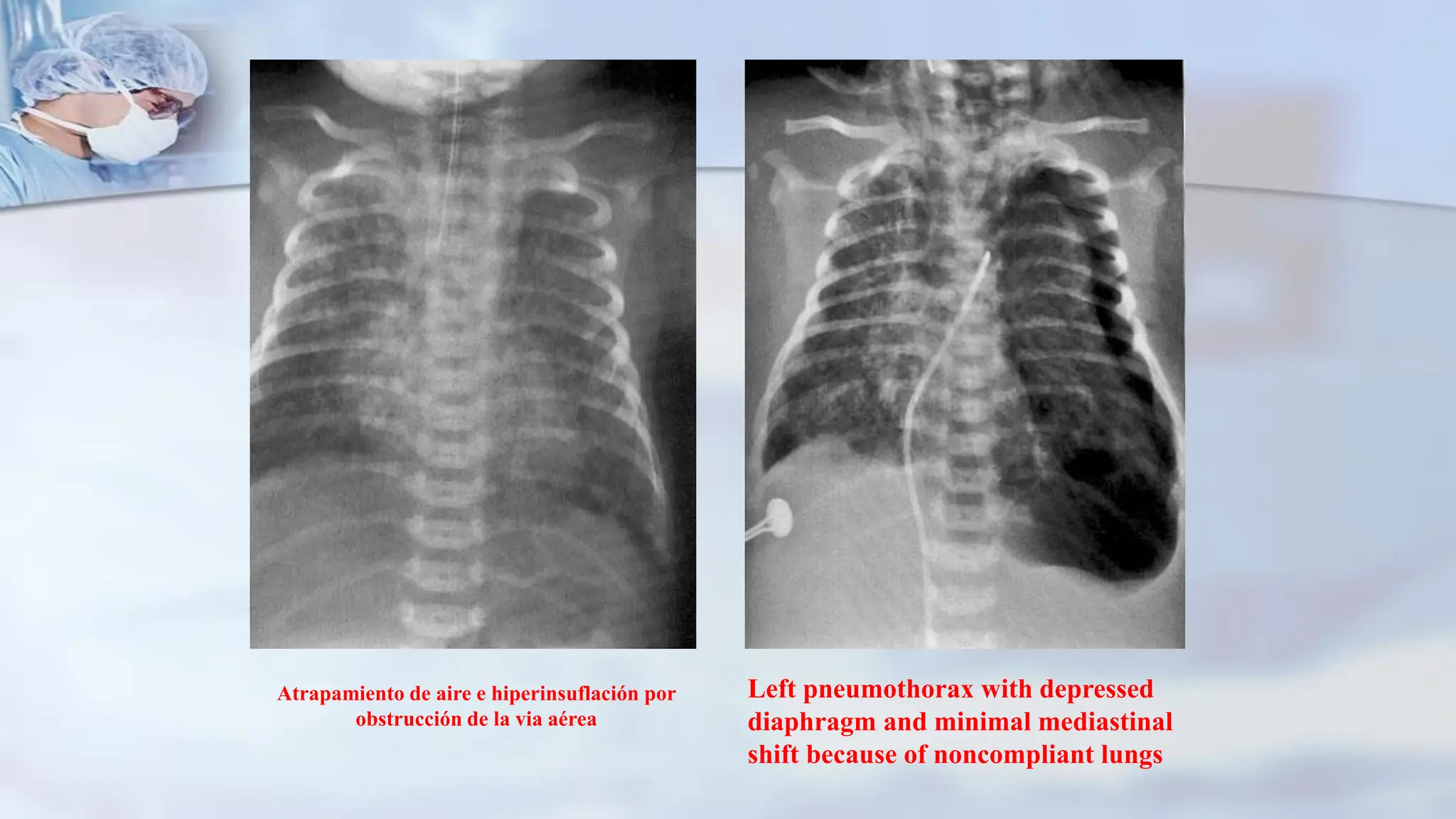 SINDROME ASPIRACION DE MECONIO EN RECIEN NACIDO POSTERMINO | PDF