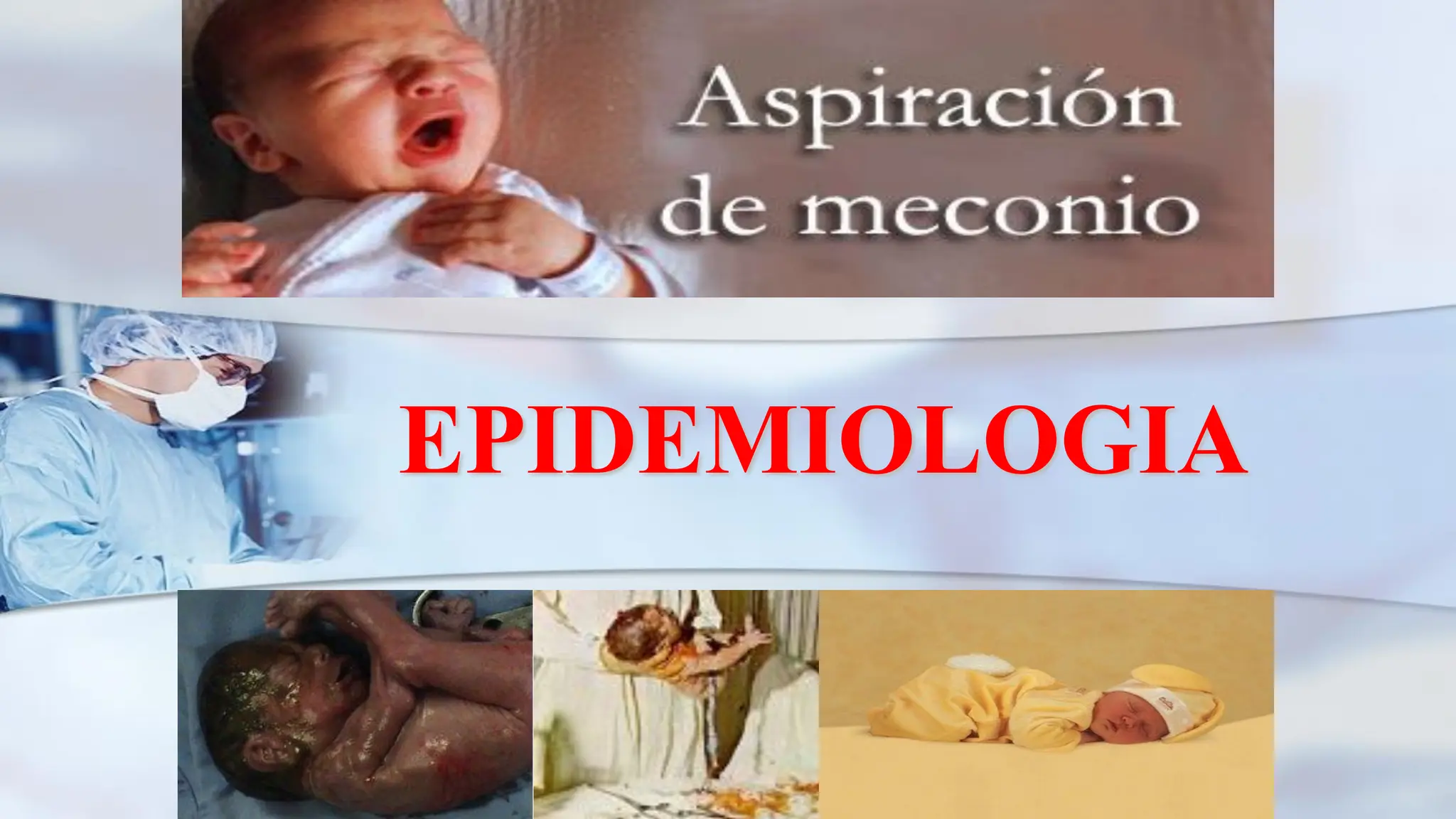 SINDROME ASPIRACION DE MECONIO EN RECIEN NACIDO POSTERMINO | PDF