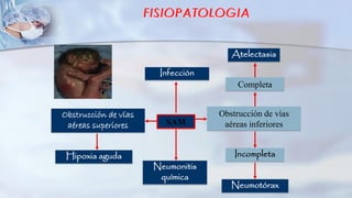 SINDROME ASPIRACION DE MECONIO EN RECIEN NACIDO POSTERMINO | PDF