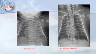 SINDROME ASPIRACION DE MECONIO EN RECIEN NACIDO POSTERMINO | PDF