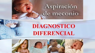 SINDROME ASPIRACION DE MECONIO EN RECIEN NACIDO POSTERMINO | PDF