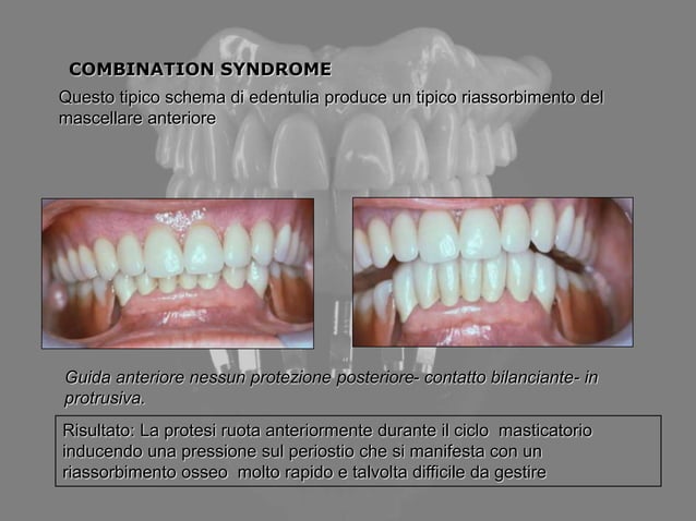 Sindrome Combinata - Combined Syndrome | PPTX | Dental Health ...