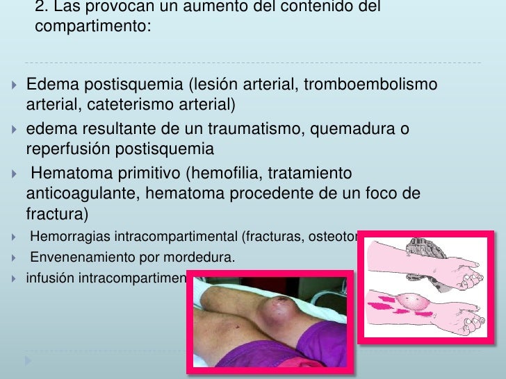 Sindrome compartimental EN TRAUMATOLOGÍA Y ORTOPEDIA