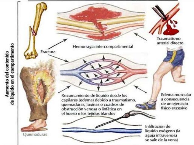 Sindrome compartimental