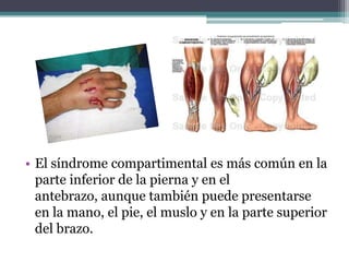 Sindrome compartimental | PPTX