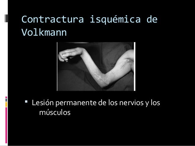 Sindrome compartimental