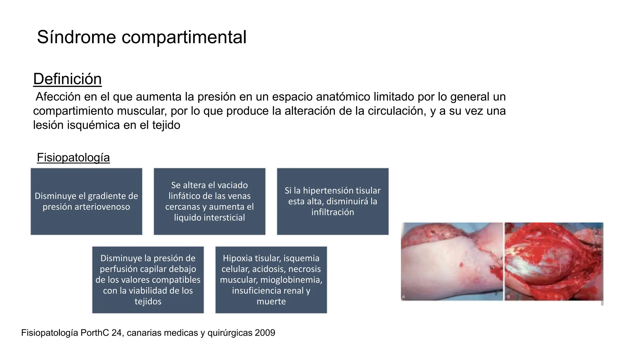 sindrome compartimental draMARIAFERNARNADA | PPTX | Diseases and ...